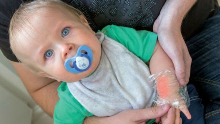 Act fast first aid for helping babies and children with burns